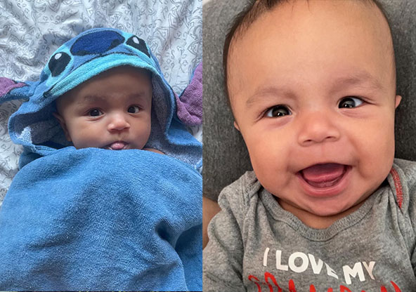 Hydrocephalus Baby Before And After