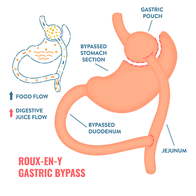 Gastric Bypass Surgery - CHRISTUS Health